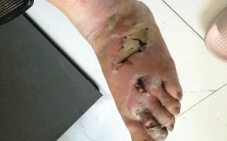 五步蛇咬了多久会死_被咬后黄金抢救时间