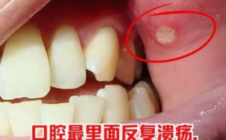 女人长期口腔溃疡是什么原因_反复溃疡怎么办