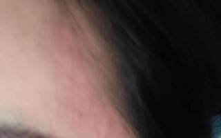 蚕豆过敏症状_蚕豆病能吃蚕豆吗