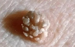 男性椰菜花病早期症状_怎么治疗彻底