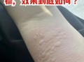 葡萄糖酸钙治荨麻疹效果怎么样_葡萄糖酸钙治疗荨麻疹用法用量