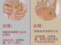 鸡眼图片大全大图_鸡眼和跖疣的区别是什么