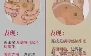 鸡眼图片大全大图_鸡眼和跖疣的区别是什么
