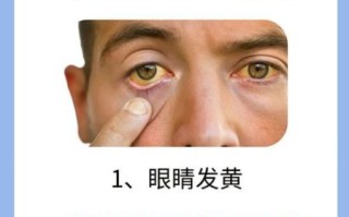 女性肝病早期有哪些症状_肝病征兆怎么判断