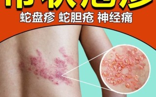 蛇胆疮怎么治疗好得快_蛇胆疮用什么药最有效