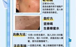 老年斑怎么去除最有效_老年斑消除最好的方法