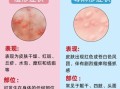 过敏性荨麻疹图片_如何辨别风团与湿疹