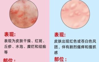 过敏性荨麻疹图片_如何辨别风团与湿疹 过敏性荨麻疹图片_如何辨别风团与湿疹
