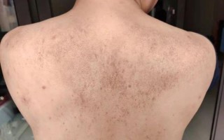 淀粉样变心肌病早期症状_淀粉样变心肌病能活多久