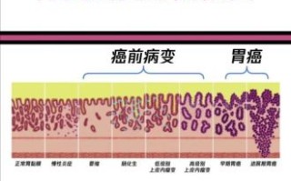 胃溃疡多久会癌变_胃溃疡癌变几率大吗