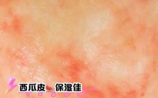 西瓜皮敷脸有什么好处_西瓜皮敷脸的正确方法