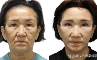 面部拉皮的最佳年龄_面部拉皮适合多大年龄