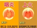 咽喉炎和咽喉癌最明显的区别_如何判断