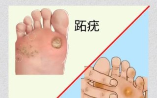 鸡眼和跖疣的区别_怎么区分鸡眼和跖疣