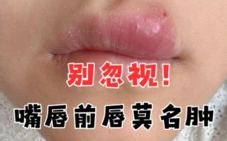 香肠嘴是怎么引起的_嘴唇突然肿厚怎么办