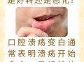 口腔溃疡变白是好转还是恶化_如何判断