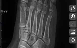 脆骨病多大就不骨折了_成年后还会骨折吗