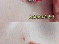 红霉素软膏的作用和功效_红霉素软膏可以涂痘痘吗
