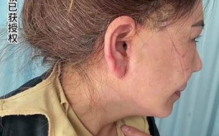 拉皮手术多久恢复自然_拉皮手术恢复期多久