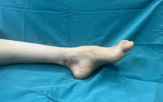 马蹄足内翻矫正手术怎么做_术后多久能走路