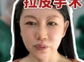 面部拉皮手术怎么做_面部拉皮能维持多久