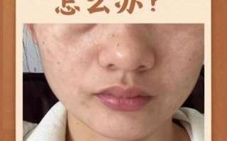 永久祛斑什么方法最好_激光祛斑会反弹吗