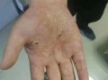 鹅掌风手干裂怎么治疗_手癣干裂最快恢复方法