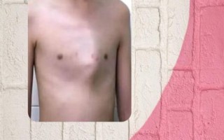 鸡胸图片宝宝2岁_鸡胸矫正方法