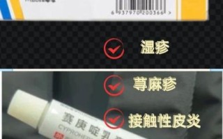 湿疹吃什么药效果最好_湿疹止痒药有哪些