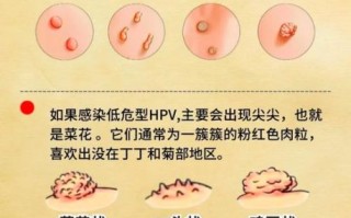 菜花状疣体是不是已经很严重了_菜花状疣体怎么治疗