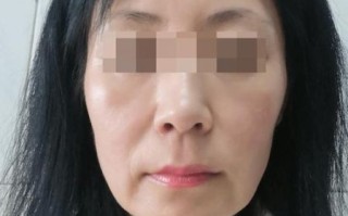 拉皮手术失败图片_如何避免拉皮失败