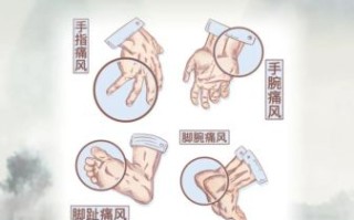 女人痛风先痛在哪里_女性痛风初期症状部位