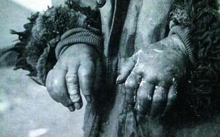 芥子气是什么_芥子气中毒怎么办