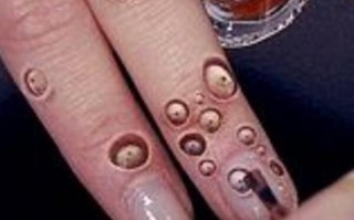 莲蓬手密集恐惧症_怎么克服