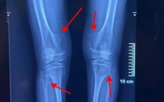 骨肉瘤能治愈吗_早期骨肉瘤治愈率有多高