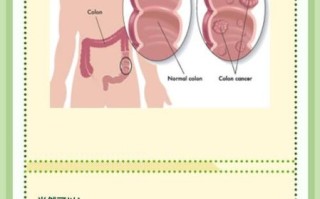 大肠癌早期信号有哪些_如何自查