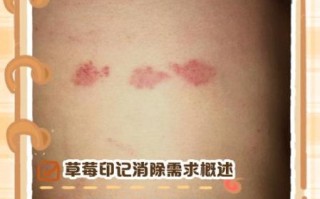 草莓印几天可以消除_如何快速淡化吻痕