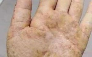 鹅掌风图片_根治特效方法