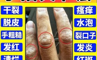 鹅掌风用什么药效果最好_鹅掌风擦什么药膏好得快