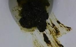 肠癌大便图片_肠癌早期大便特征