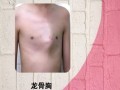 轻度鸡胸图片_轻度鸡胸会自愈吗