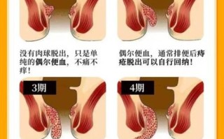 痔疮一期二期三期图片_如何区分严重程度