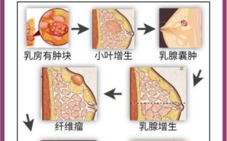 乳腺增生严重吗_乳腺增生会癌变吗