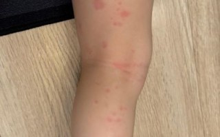 过敏性皮炎图片_怎么判断是不是过敏性皮炎