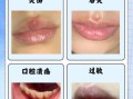 嘴唇起泡是什么原因_睡一觉醒来上唇肿了怎么办