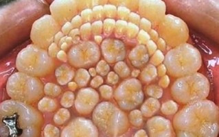 莲蓬乳皮肤病图片_怎么辨别真假