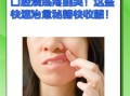 口腔溃疡一夜见效偏方_口腔溃疡怎么快速止痛