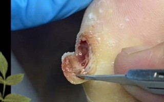 鸡眼挖出来后是什么样子_鸡眼根会一起掉吗