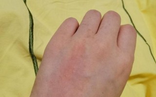 怎么判断自己海鲜过敏_海鲜过敏症状有哪些