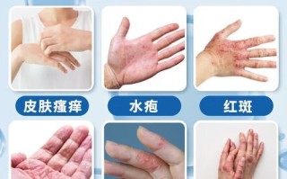 鹅掌风怎么治疗_鹅掌风用什么药膏